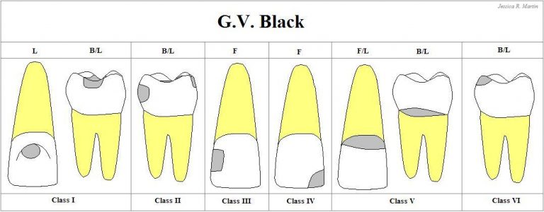 Klasifikasi Karies Gigi Menurut G. V. Black - doktergigi.net